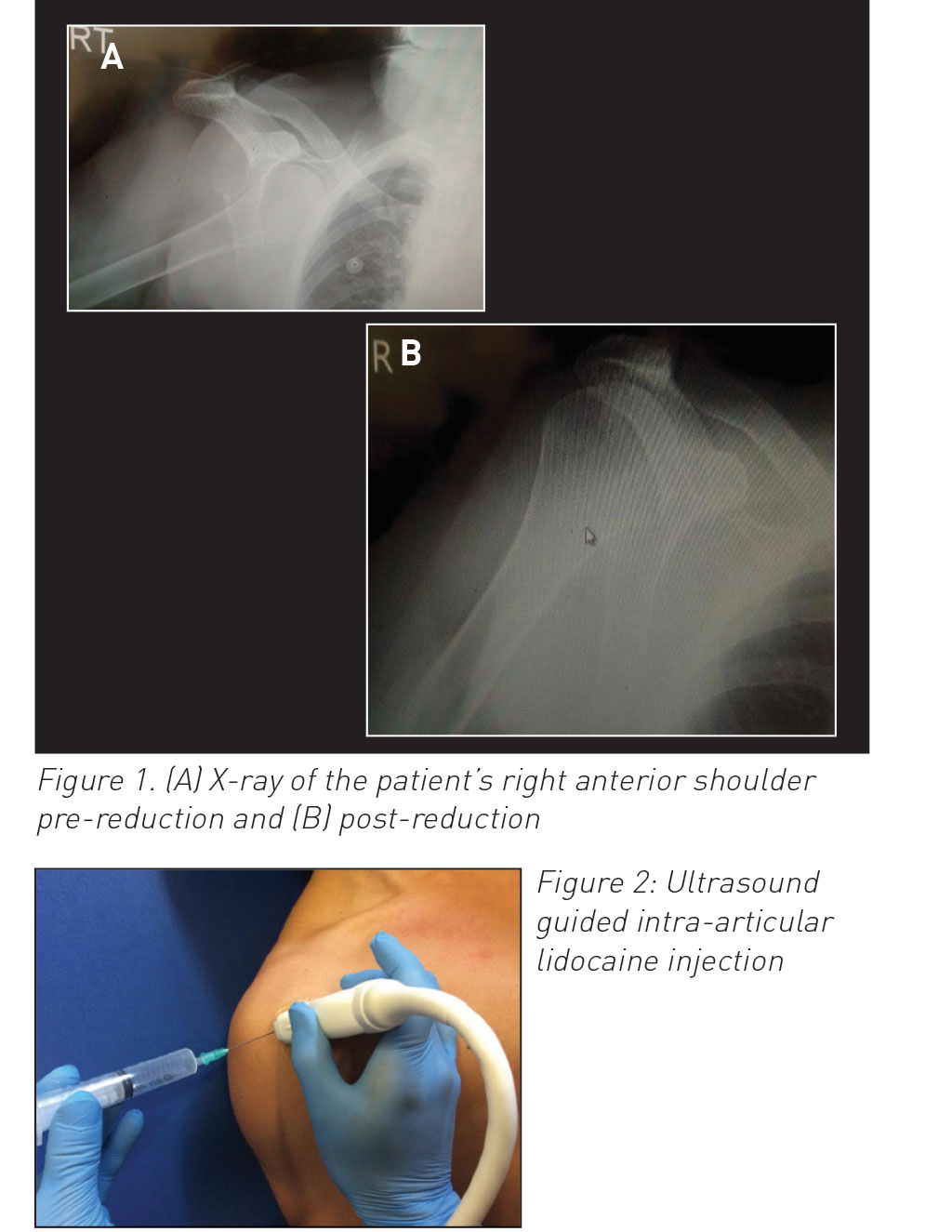 Intra Articular Lidocaine Injection For Shoulder Dislocation